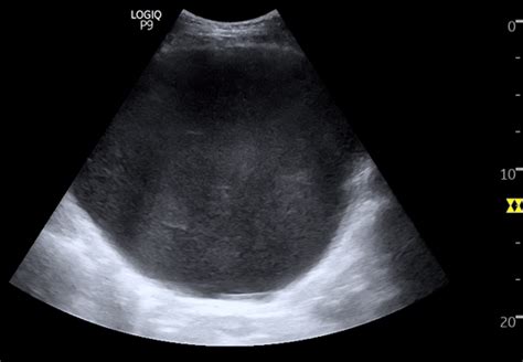 A Case Of Hydronephrosis Nephropocus