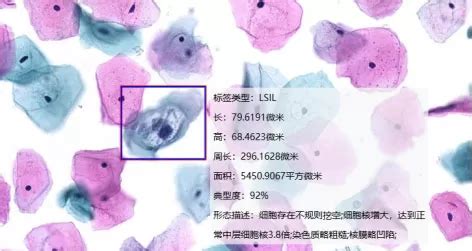 Interpretation Essentials Of Low Grade Squamous Intraepithelial Lesion