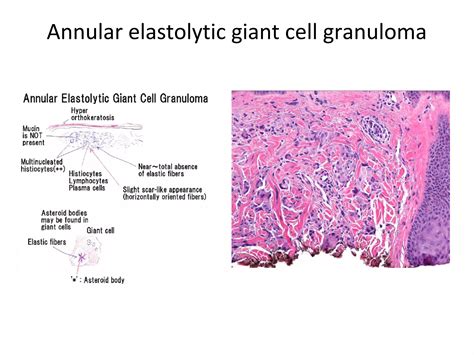 Granuloma Annulare 2 0 Ppt