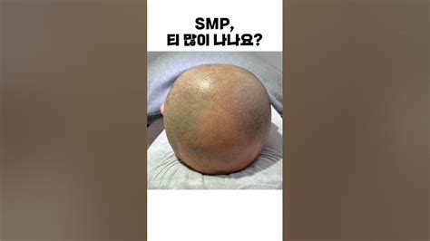 망하고 레이저는 돈이 두배 세배 네배 Smp 두피문신 두피문신수강 삭발문신 두피문신후기 장유두피문신 김해두피문신 오필두피문신 여자헤어스타일 모발이식