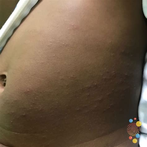 Miliaria Crystallina