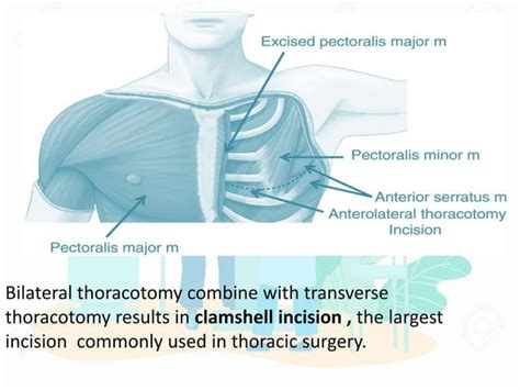 Thoracotomy Pptx