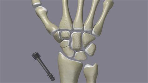 Scaphoid Fractures Youtube