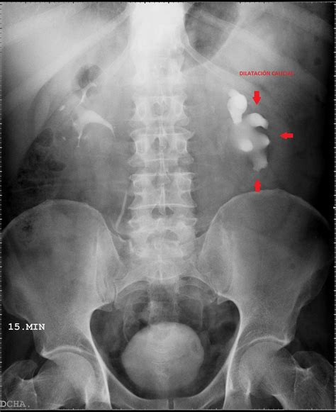 Anatomía Radiológica De Pelvis Y Abdomen Riñones Vía Urinaria