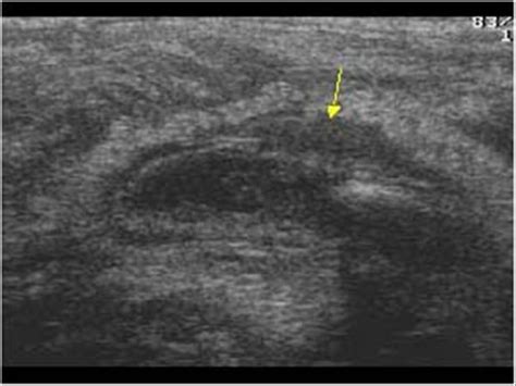 Abdomen And Retroperitoneum 1 5 Appendix Case 1 5 3 Complicated
