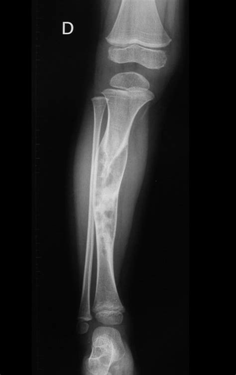 Osteofibrodisplasia Técnica De Tibialização Da Fíbula