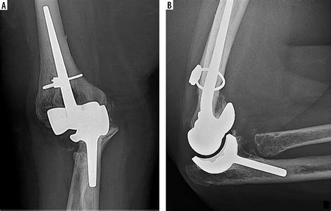 Update On Elbow Arthroplasties With Emphasis On Imaging