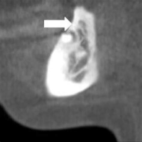 Sagittal Section Of Cbct Illustrating Type B Canals Ran Between The Download Scientific