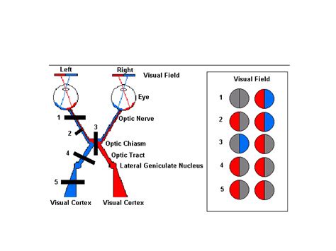 Visual Pathway Visual Cortex And Hemianopias Pptx