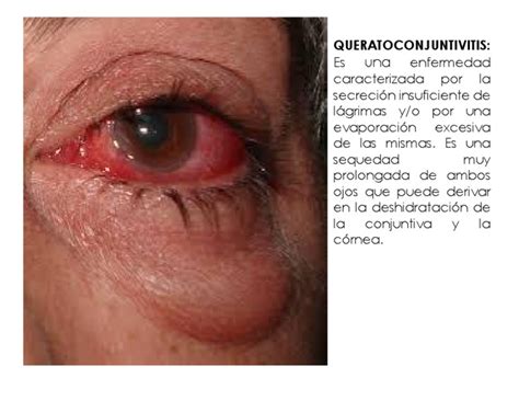 Queratoconjuntivitis Pdf