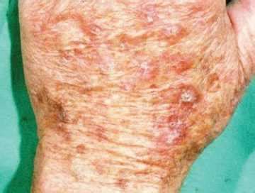 Actinic Keratosis Treatment Epiphany Dermatology