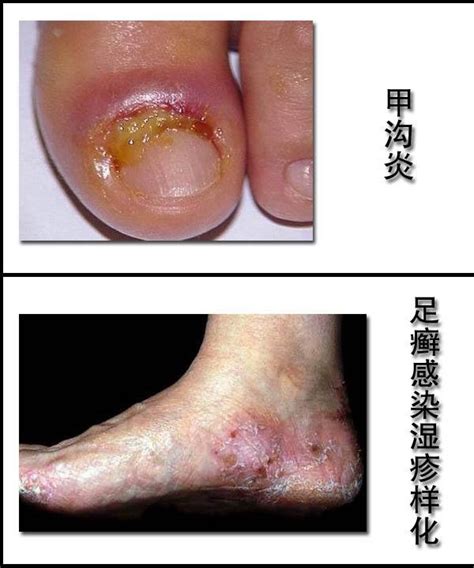 皮肤细菌感染图片 图库 五毛网