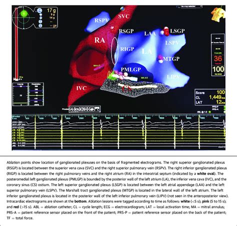 Biatrial Electroanatomic Maps Obtained Using The Ensite Precision