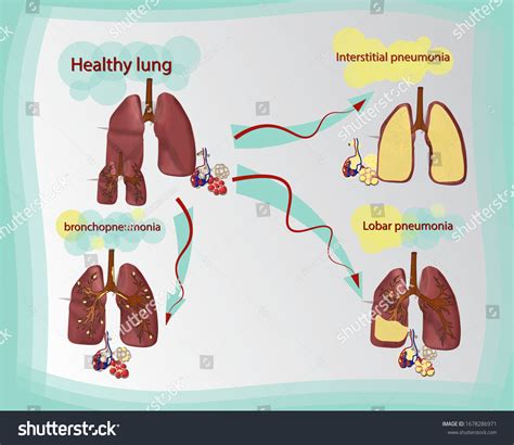 Poster Picture Types Pneumonia Vector Graphics Stock Vector Royalty Free Shutterstock