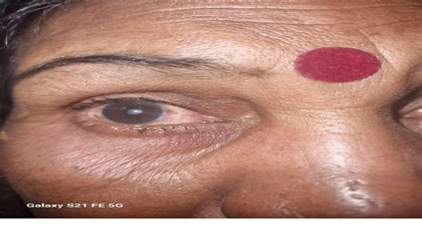 The Primary Angle Closuree Glaucoma Pptx