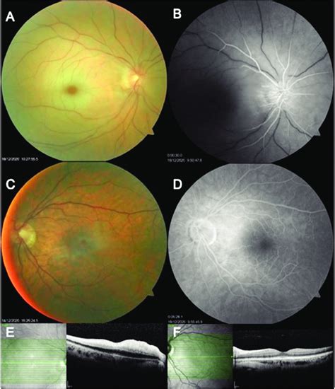Fundus Photography Fundus Fluorescein Angiography Ffa And Optical