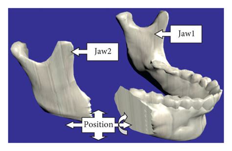 Repositioning Of Mandible Fragments Jaw 1 And Jaw 2 Download