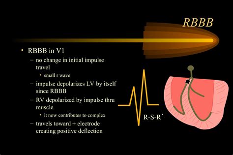 12leadblocks Ppt 12 Lead Bundle Branch Block Ppt