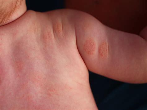 Eczema Numular Drug Induced Nummular Dermatitis Hoogstra Medical