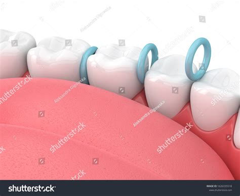 3d Render Rubber Separators Between Teeth Stock Illustration 1626335518