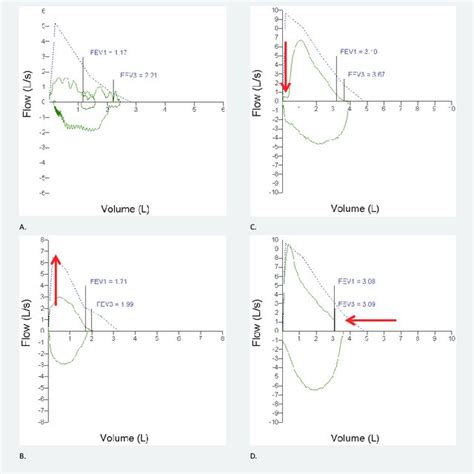 Pdf Basic Spirometry Testing And Interpretation For The Primary Care Provider