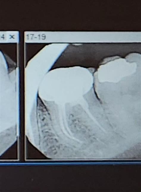 Can You See Anything Wrong With This Root Canal R Askdentists