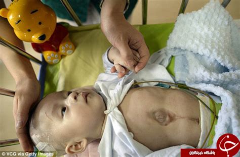 پیدا کردن نوزاد سر راهی با قلبی خارج از سینهتصاویر