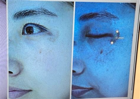 부산 근교김해 흑자제거 리팟레이저로 말끔하게 제거 후기 네이버 블로그