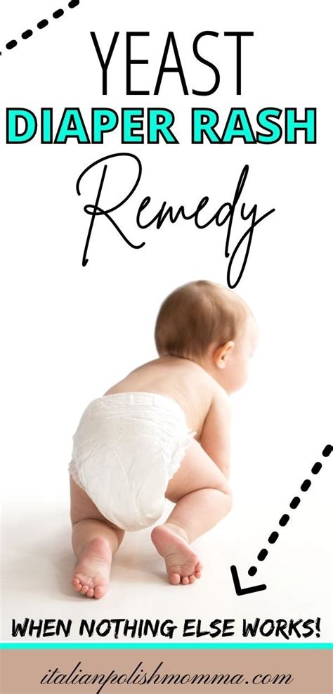 Yeast Diaper Rash Home Remedy Artofit