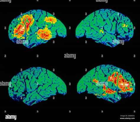 Left Right Handedness Language In Brain Colour Positron Emission Tomography PET Scan Of