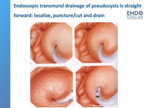 Endocollab™ Gastroenterology And Endoscopy Education On Linkedin 🔥 Pseudocyst Drainage Made