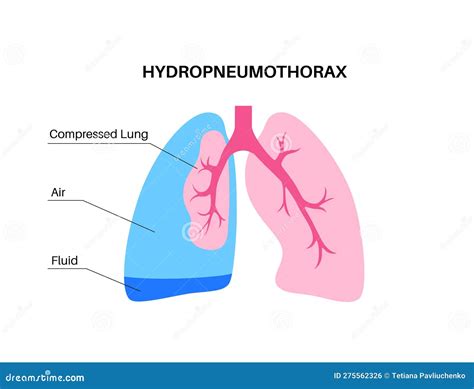 Hydropneumothorax Medical Poster Vector Illustration 275960100