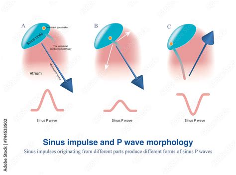 Sinus Impulses From Different Parts Of The Sinoatrial Node Produce