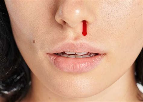 เลือดกำเดาไหล เกิดจากอะไร ทำยังไงถึงจะหยุดไหล