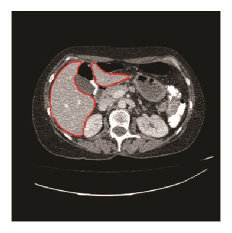 Some Randomly Selected Liver Segmentation Results Denoted In Red