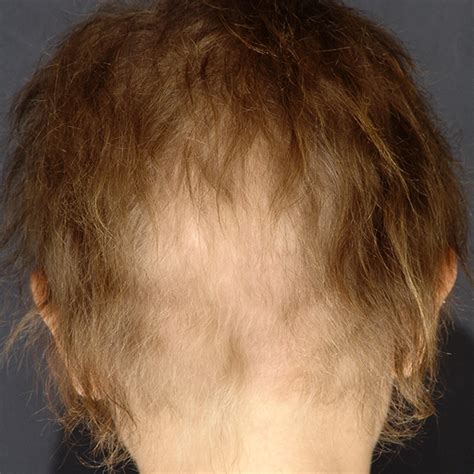 Ectodermal Dysplasia Casa Santa Teresinha