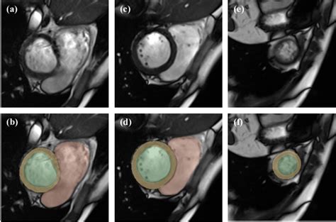 Visual Example Of Segmentation Masks In Task 2 Basal Slice Image A