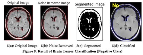 Real Time Multi Fractal Ensemble Analysis Cnn Model For Optimizing Brain Tumor Classification