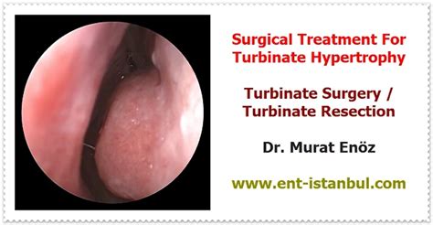 Turbinate Hypertrophy Definition Symptoms Causes And Treatment