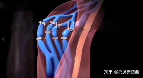 医生建议精索静脉曲张手术或不手术的依据是什么？ 知乎