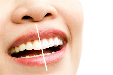 Best Teeth Whitening Toothpaste Msd Dental Studio