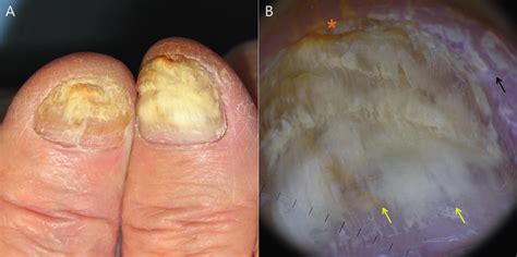Onychomycosis A Clinical Photography Of Onychomycosis Shows The