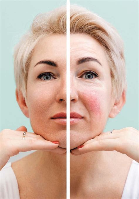 Ruddy Complexion Treatment