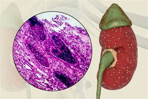Pyelonefritis Akut Ilustrasi Menunjukkan Morfologi Kotor Dengan Abses