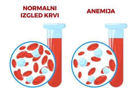 Sve O Anemiji Miter International