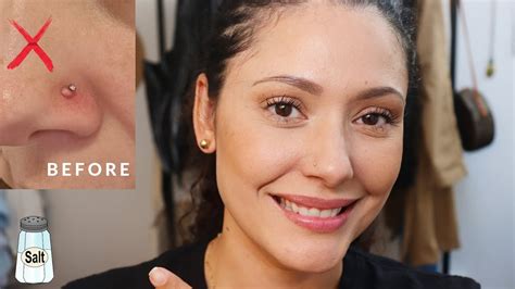 How To Get Rid Of A Keloid On Nose Detroit Chinatown