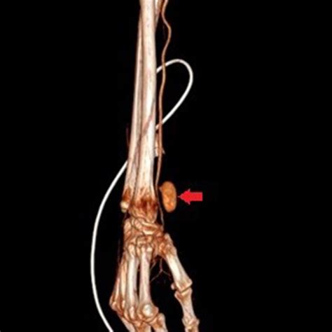 Pdf Radial Artery Pseudoaneurysm After Transradial Cardiac