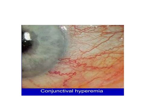 Hyperaemia Congrstion Haemoorhage Cvc Spleen Ppt