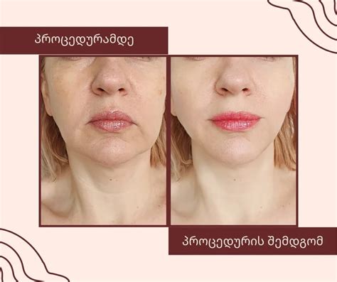 Derma კლინიკა დერმა გთავაზობთ სახის კანის მოვლის და მოდელირების პროცედურას სპეციალურ ფასად 👉
