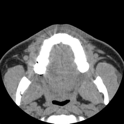 Normal Sinus Ct Annotated Radiopaedia 78917 91810 Axial Non Contrast Nc Commons